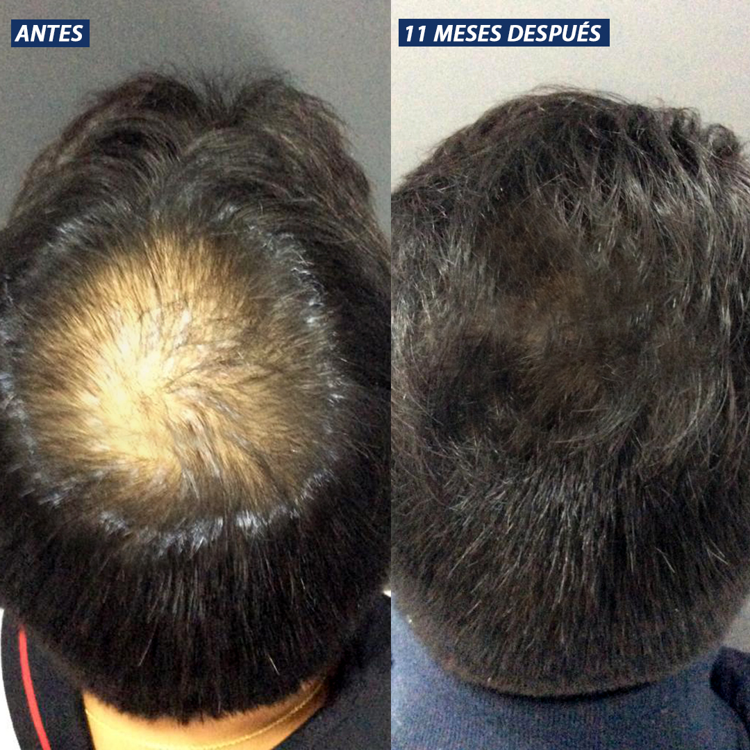 Injerto capilar en Valencia al mejor precio - Unidad Capilar Corporal Core